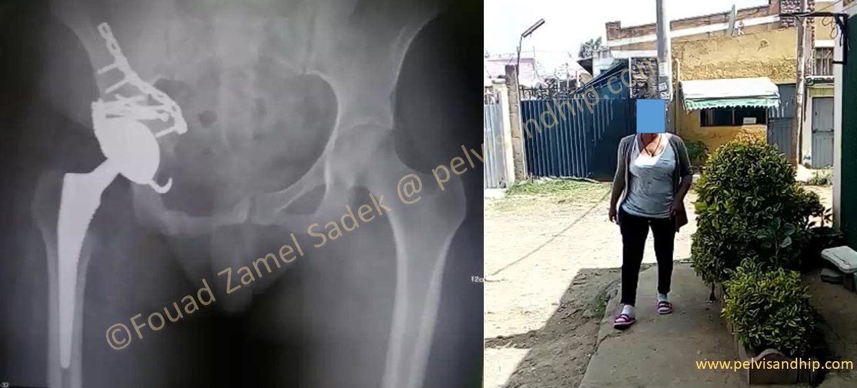 case 10 hip – Professor Fouad Zamel Sadek